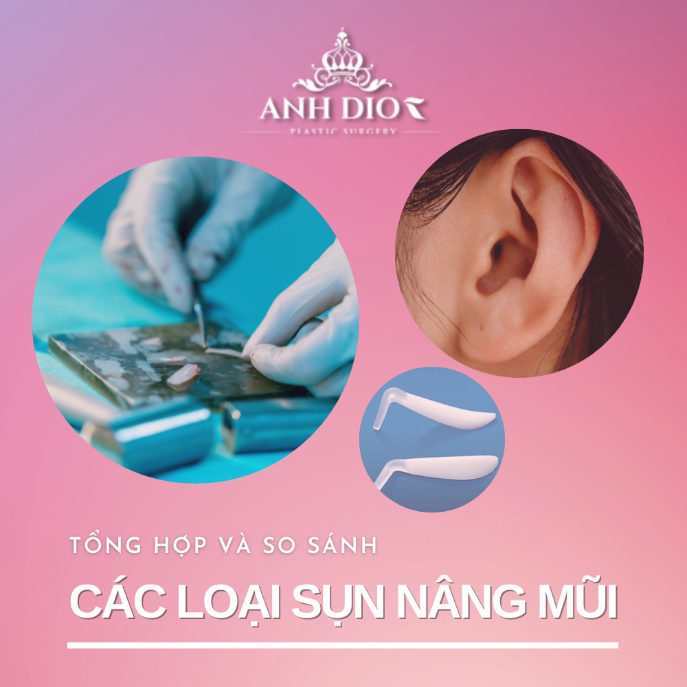 Tổng hợp chi tiết về các loại sụn nâng mũi - Ưu nhược điểm của mỗi loại